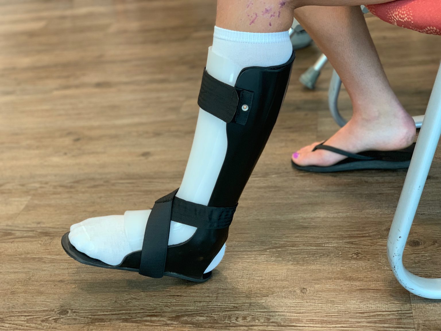 » Thermoplastic AFO Innovative Prosthetic Solutions, Inc.