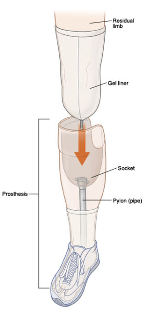» What Makes Up A Prosthesis: Components Lower Extremity Innovative Prosthetic Solutions, Inc.